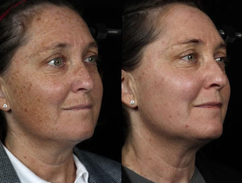 PEARL LASER RESURFACING … – 318Central